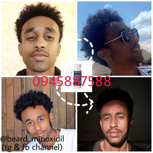 Telegram channel "ፀጉር እና ፂም ማሳደጊያ(minoxidil beard)" — @beard_minoxidil ...
